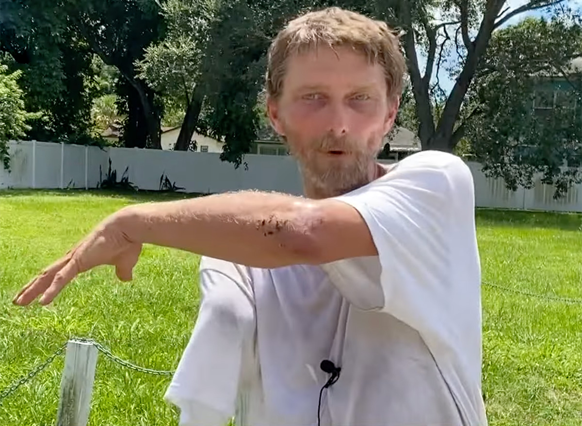 Man Survived for 3 Days in Swamp After an Alligator Bit Off His Arm